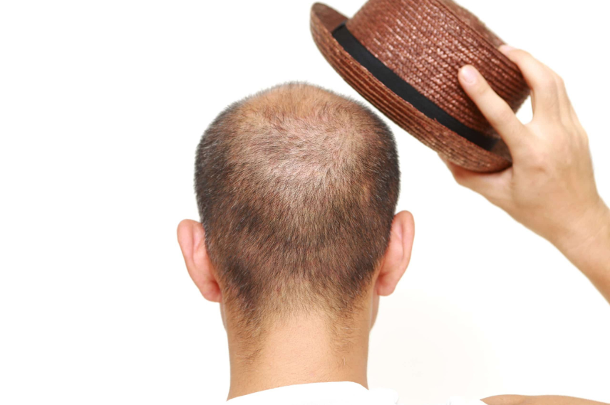 7 Popular Hair Loss Myths Debunked | HAIRFIX
